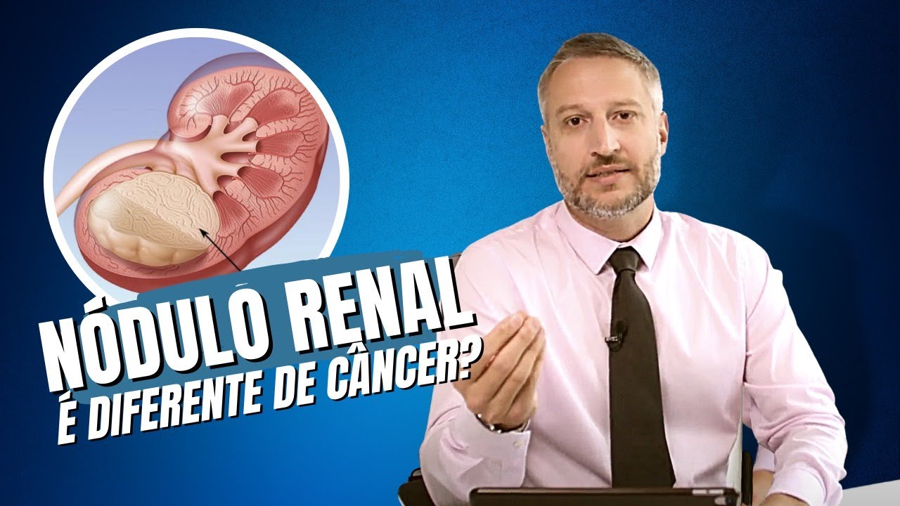 O que são nódulos renais?
